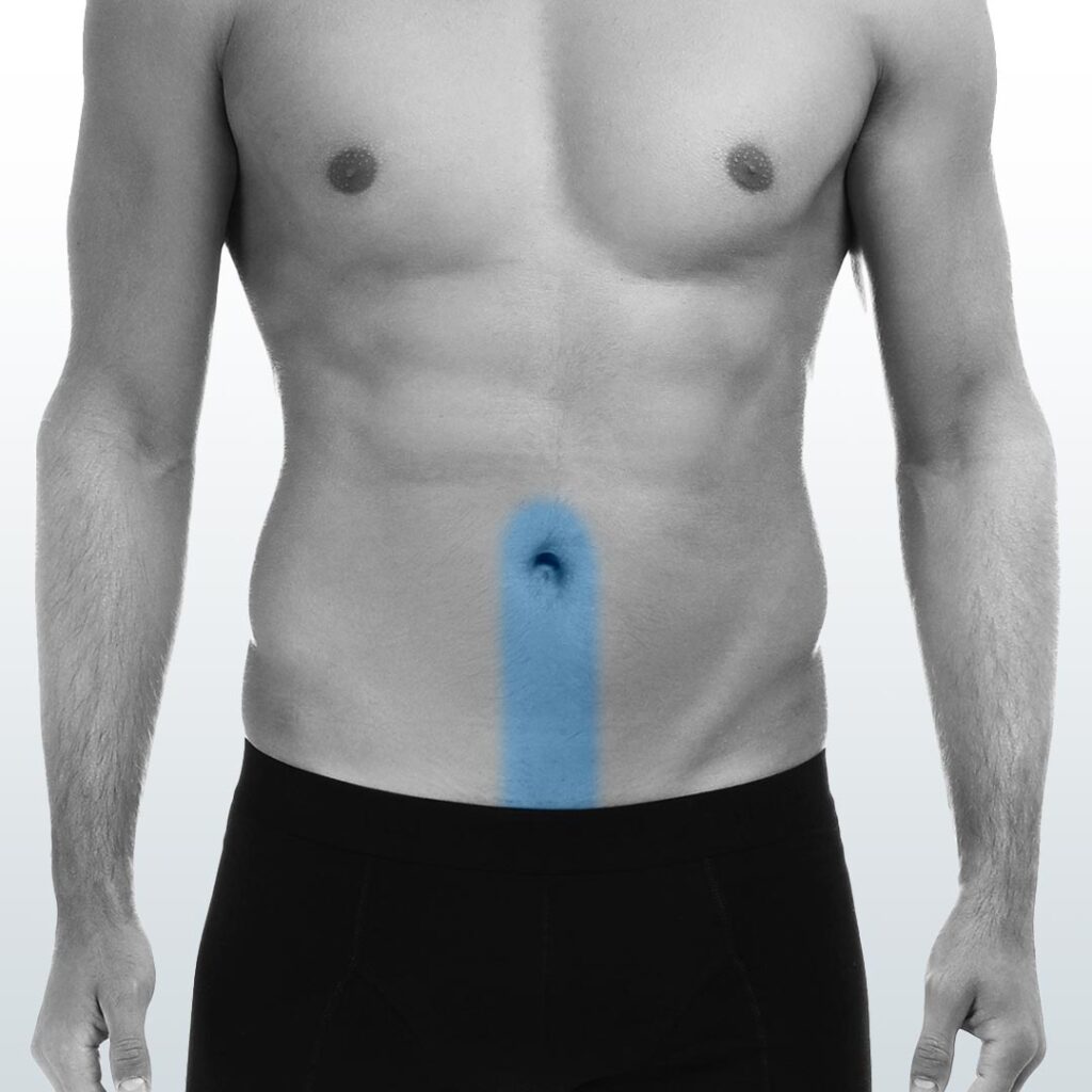 Depilación Línea Alba (S) – Aura Laser